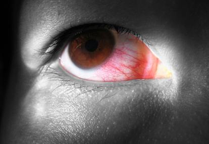 Saat Mata Alergi, Lakukan Ini