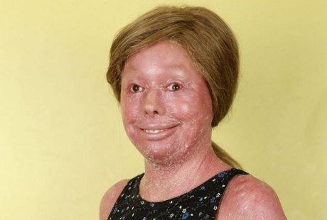 Kelainan Kulit, Gadis Ini Tak Bisa Merem dan Rambutnya Tak Bisa Tumbuh