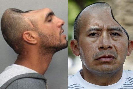 5 Pria Berkepala 'Alien', Bertahan Hidup Meski Tengkorak Tinggal Separuh