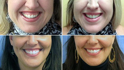 Rahasia Senyum Menawan Wanita Hollywood: Botox Bibir Atas