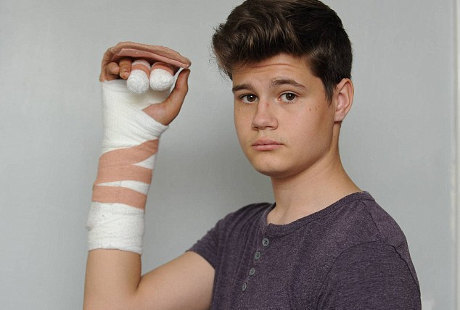 Iseng-iseng Main Kembang Api, Jari Tangan Remaja 15 Tahun Terbakar