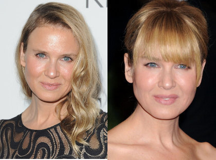 Takut Gagal Botox Seperti Renee Zellweger, Wanita Mulai Beralih ke Notox