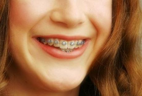 Konsultasi Gigi: Solusi Bagi Gigi yang Tidak Rapi