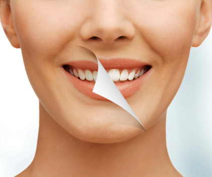 Setelah Rapi dengan Behel, Ini Perawatan Gigi yang Jadi Favorit