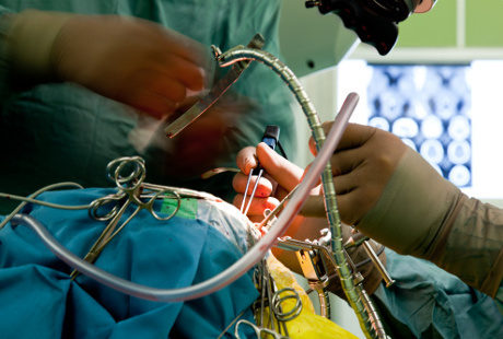 Operasi Otak Parkinson Bisa Permanen atau Tidak, Kenali Perbedaannya