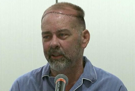 Transplantasi Tengkorak Pertama Sukses Dilakukan di Texas