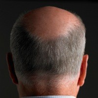 Cangkok Rambut untuk Mengatasi Kebotakan