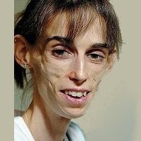 Korban Anoreksia Terparah yang Akhirnya Tak Bisa Bertahan Hidup