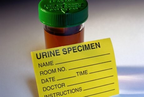 Warna-warna Urine dan Indikasi Kesehatannya
