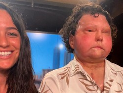 8 Foto Pria Pertama dengan Transplantasi Wajah Bertemu Jodoh, Kini Tunangan