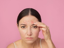 7 Letak Jerawat dan Artinya, Waspada Jika Berjerawat di Dahi hingga Dagu