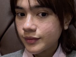 Foto: Transformasi Model dengan Pipi Terbesar, Before-After Suntik Filler